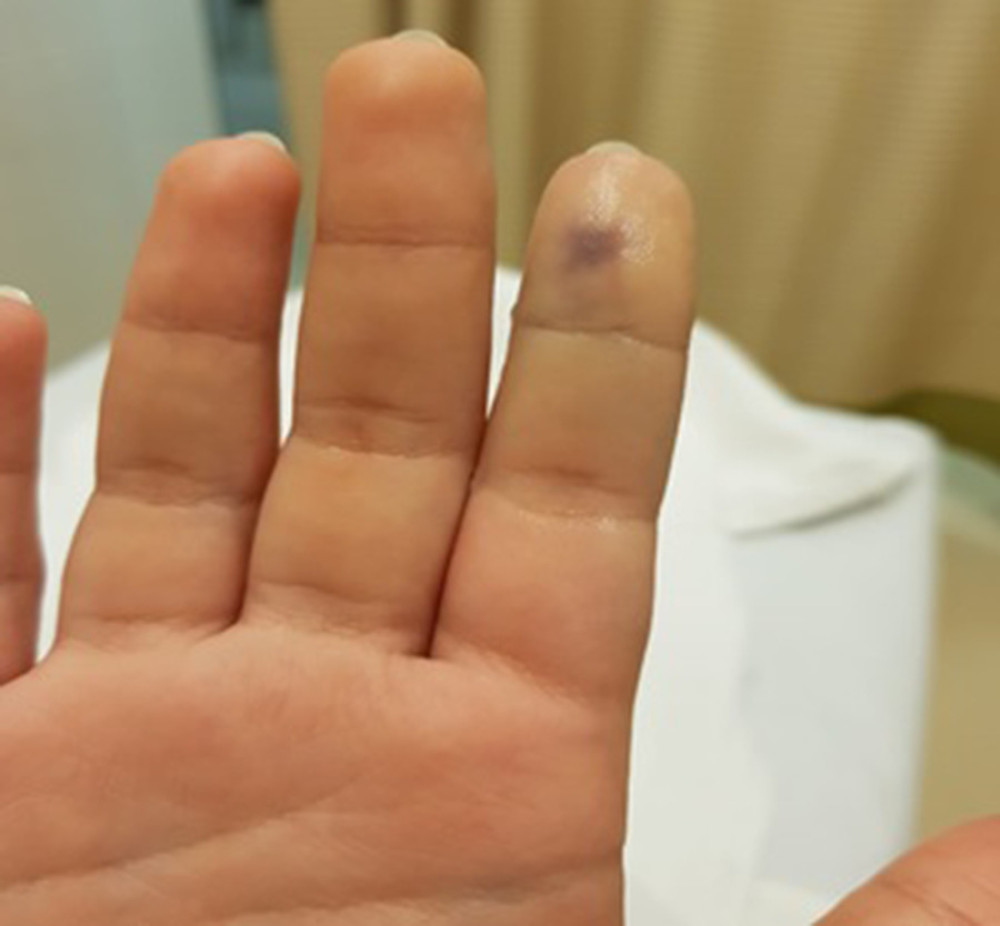 American Journal of Case Reports | Reversal of Digital Ischemia with ...