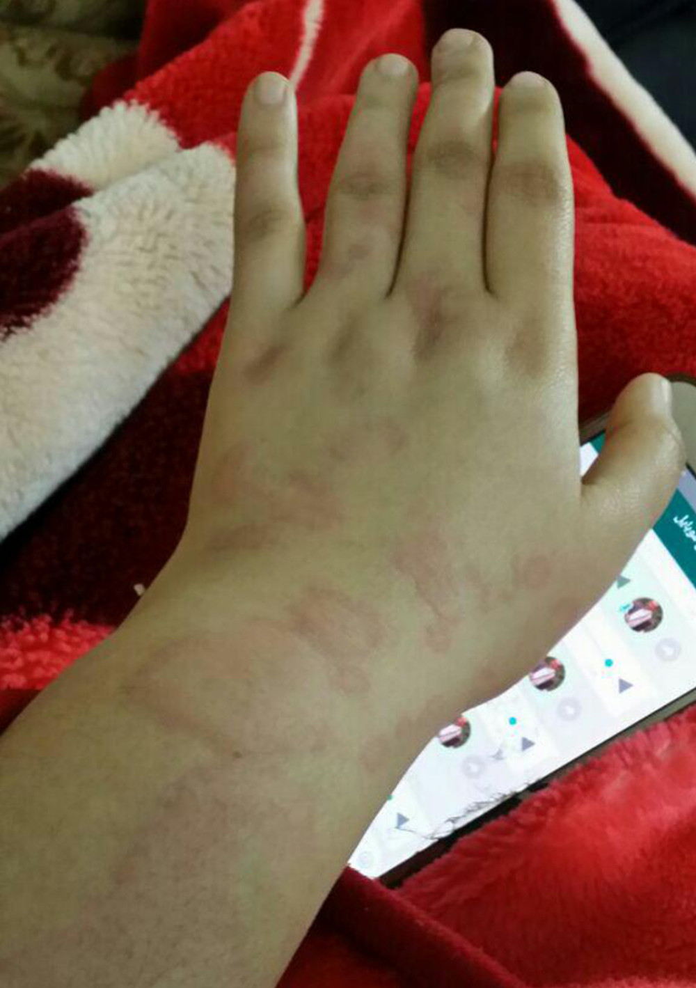 American Journal of Case Reports | Refractory Urticaria with Raised ...