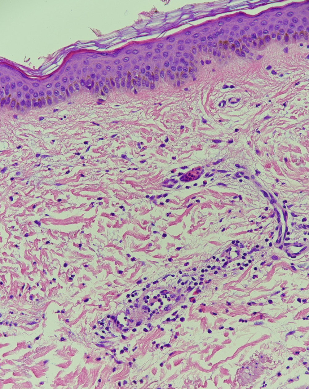 American Journal of Case Reports | Refractory Urticaria with Raised ...