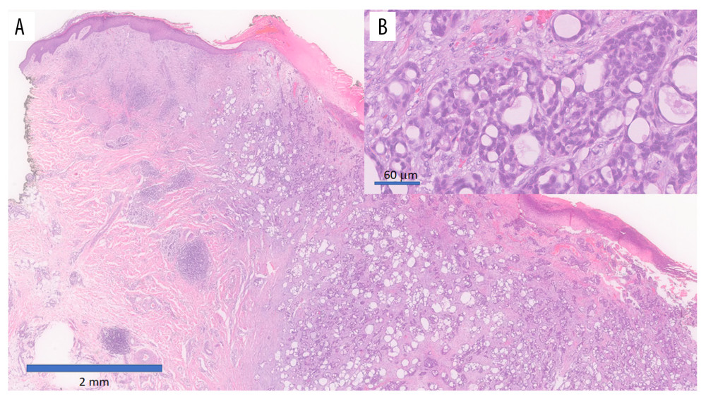 American Journal of Case Reports | Primary Cutaneous Cribriform ...