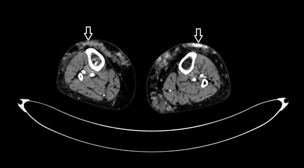 American Journal of Case Reports | The Multifactorial Pathogenesis of ...