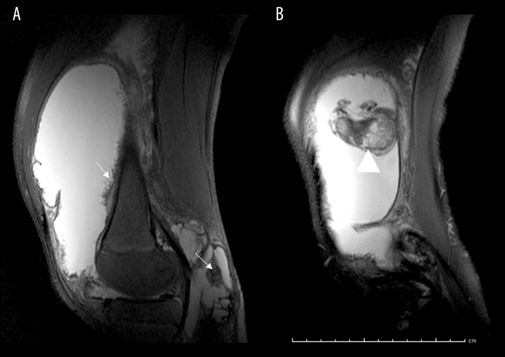 American Journal of Case Reports | Post-Traumatic Hemosiderotic ...