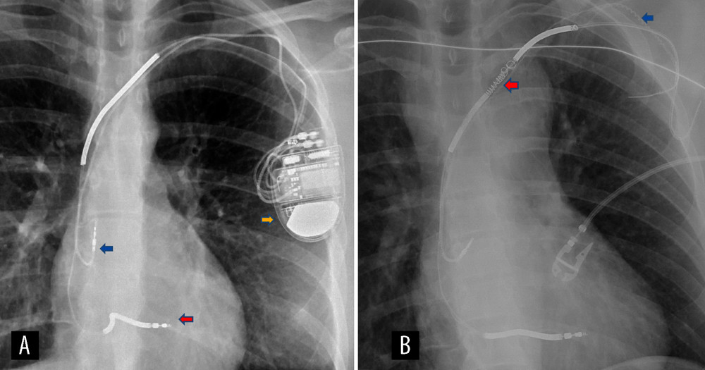 Implantable Cardioverter Defibrillator Medtronic