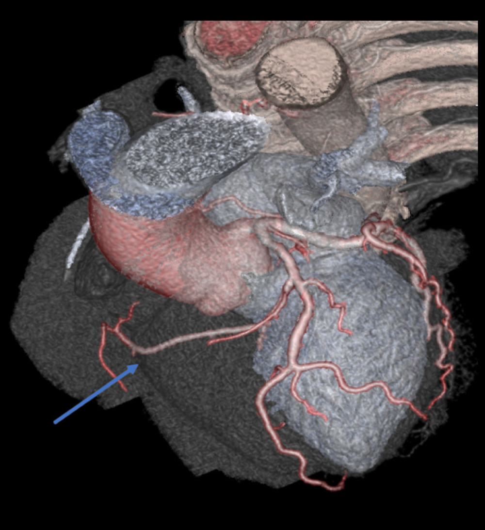 American Journal of Case Reports | A Rare Anatomical Variant ...