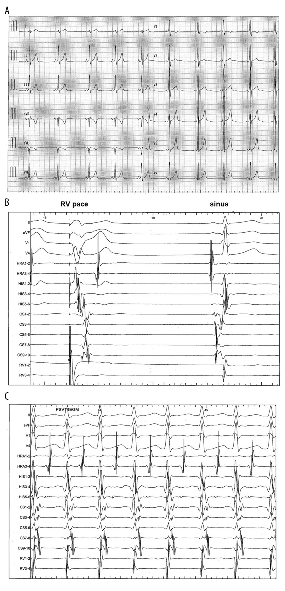 American Journal of Case Reports | Sequential Abolition of Antegrade ...