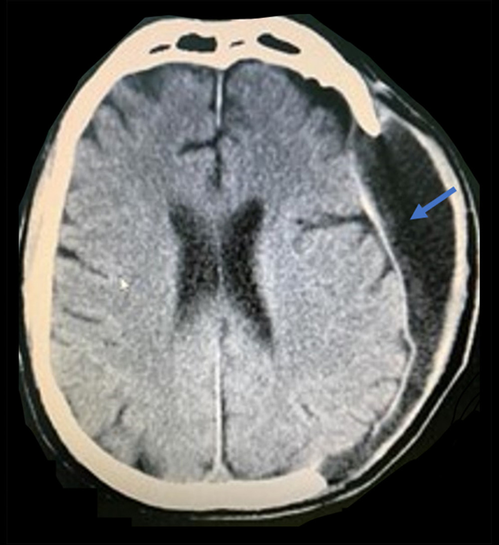 American Journal of Case Reports | Case Report: Surgical Management in ...