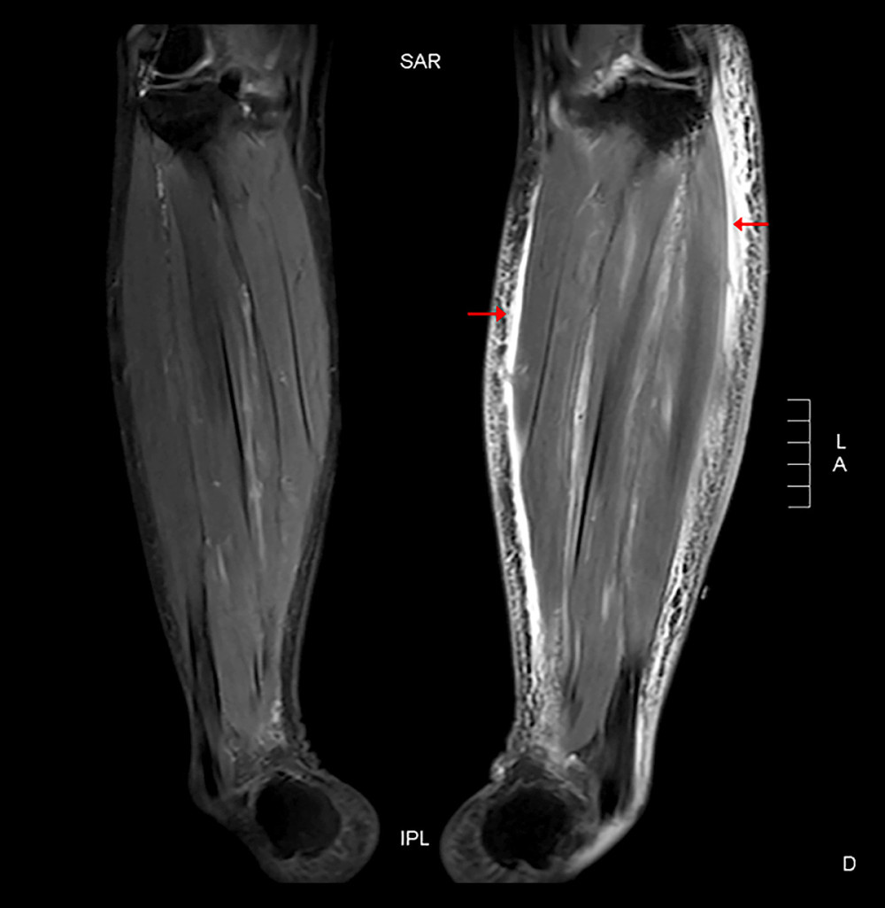 American Journal of Case Reports | Pyoderma Gangrenosum Mimicking ...