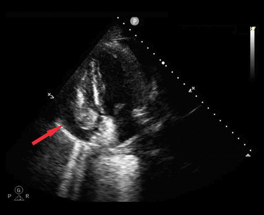 American Journal of Case Reports | A 39-Year-Old Woman with Ventricular ...