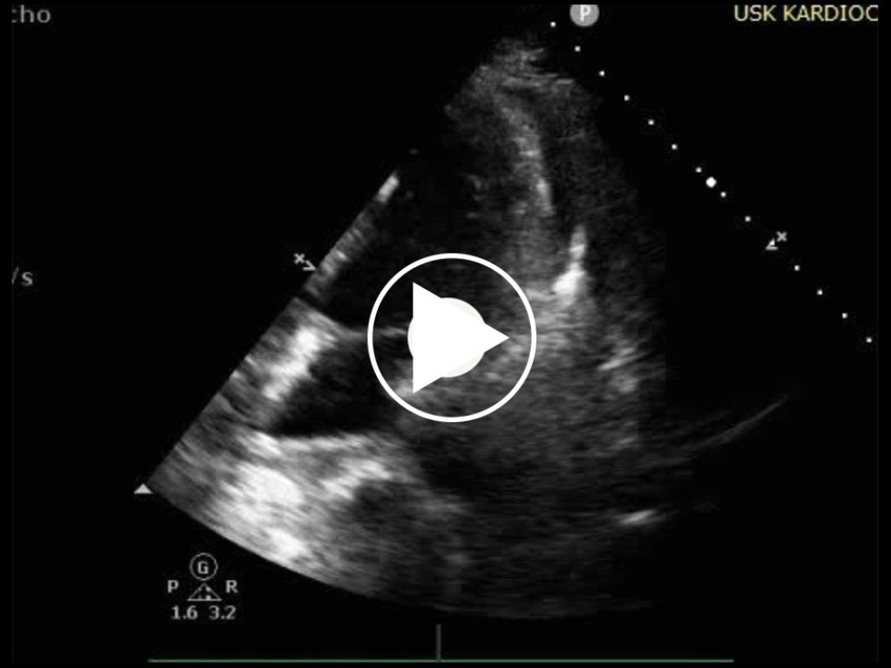 American Journal of Case Reports | A 39-Year-Old Woman with Ventricular ...