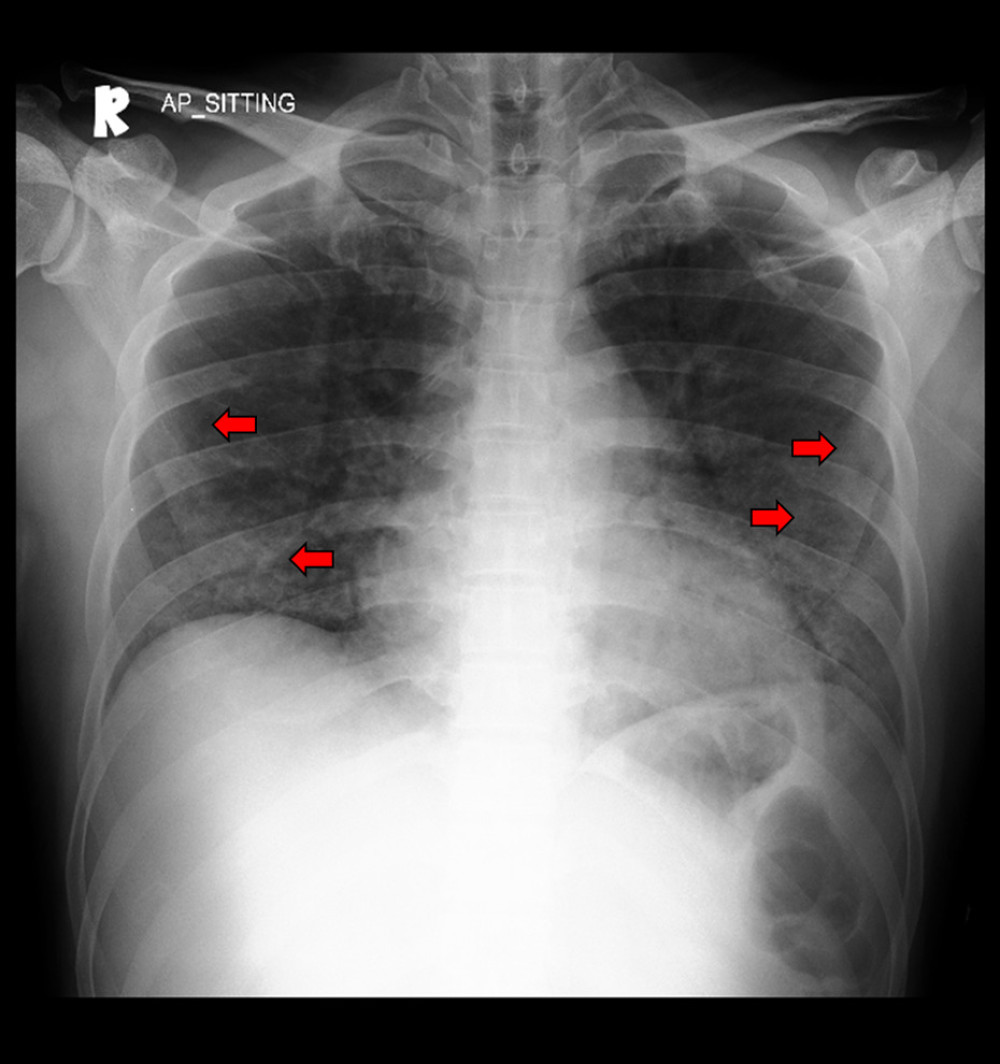 Pneumonia Chest X Ray Pediatric Chest X Ray In Covid 19 Infection