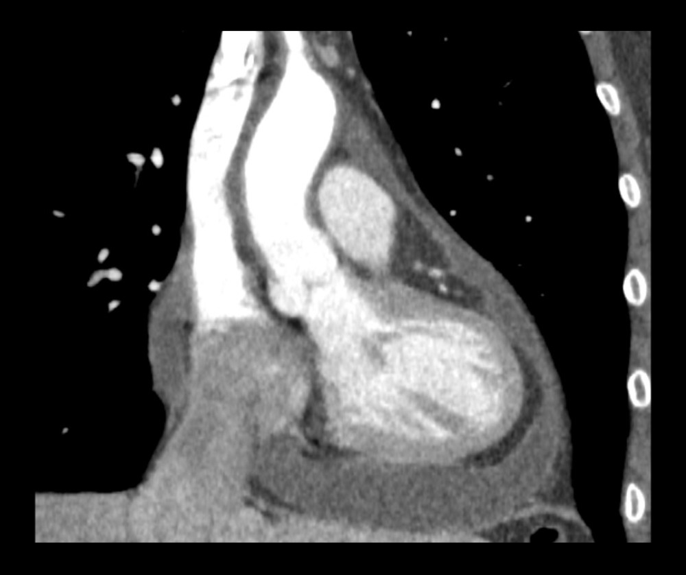 American Journal of Case Reports | Inflammation of Pericardial ...