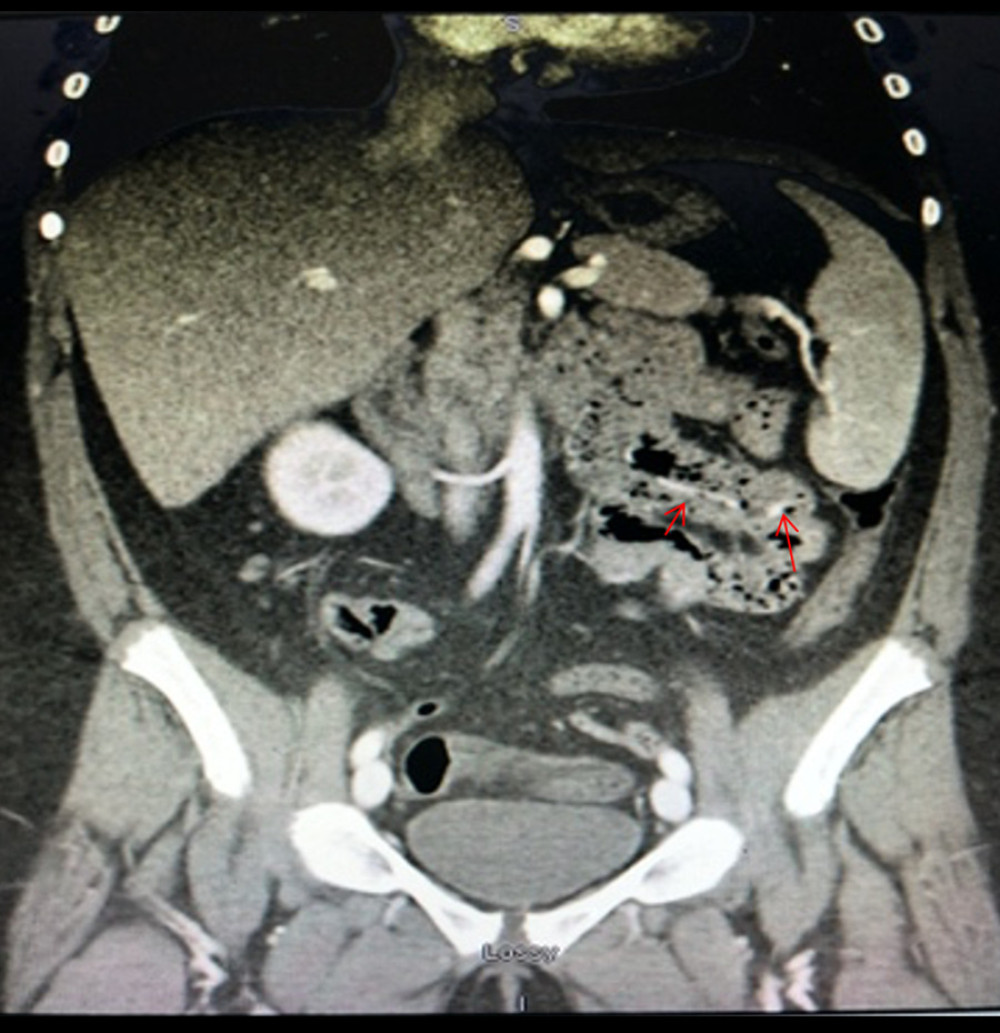 American Journal of Case Reports | Recurrent Gastrointestinal Bleed Due ...