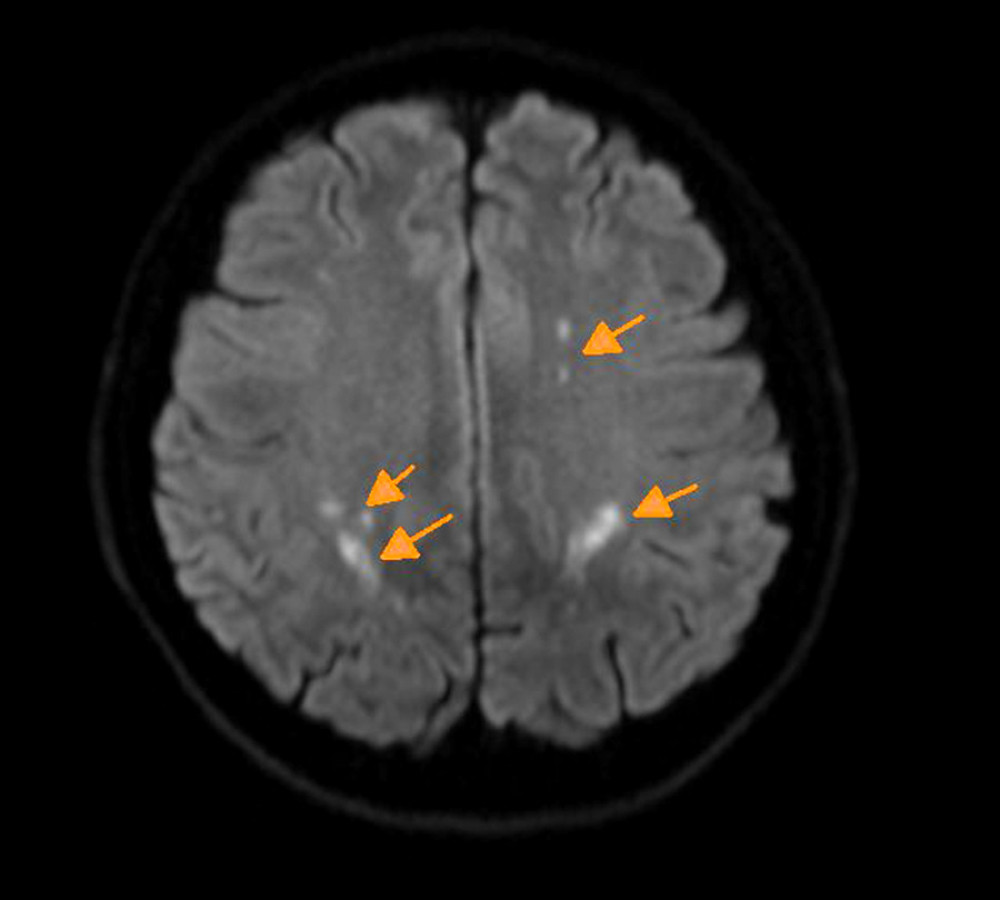 American Journal of Case Reports | Encephalopathy as the Only Manifestation in Simultaneous ...