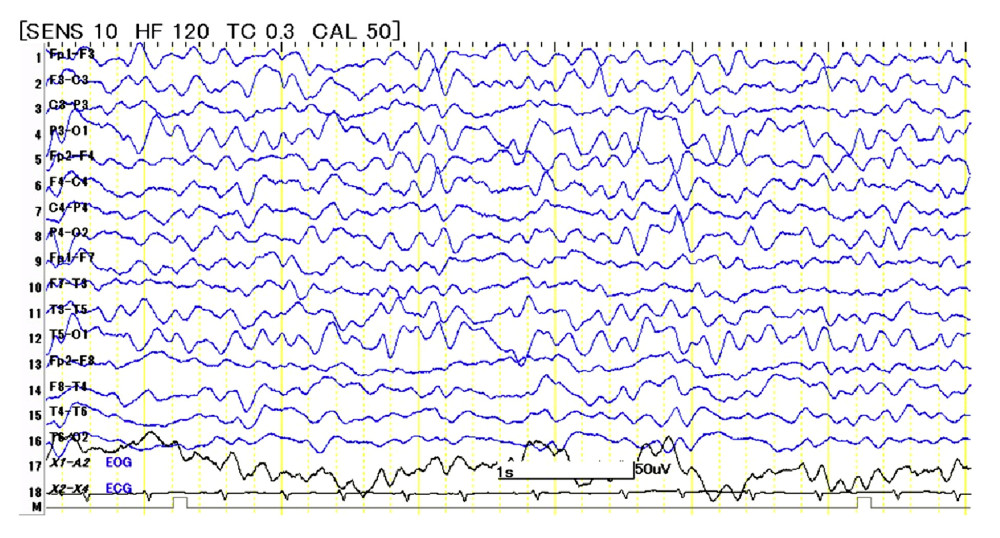 Creutzfeldt Jakob Disease Eeg