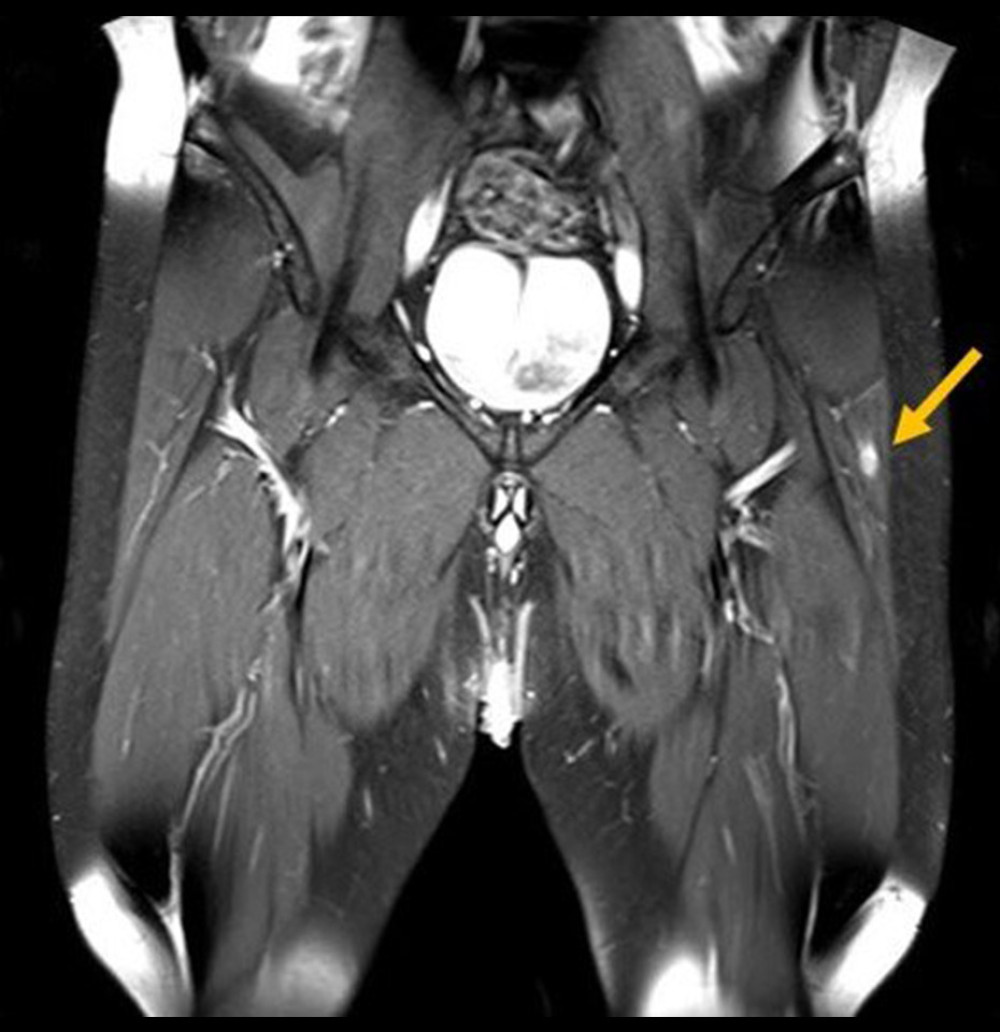 American Journal of Case Reports | Glomus Tumor Within the Tensor ...