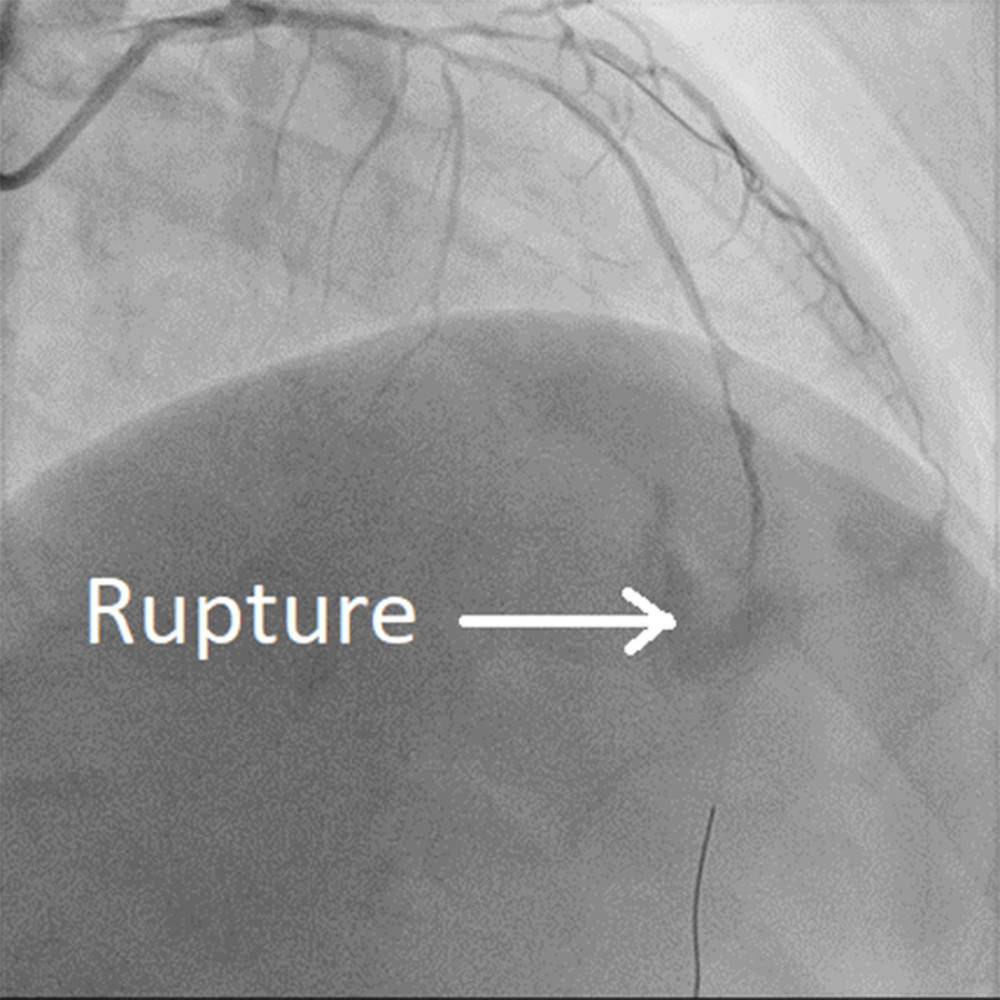 American Journal of Case Reports | Two Cases of Management of Coronary ...