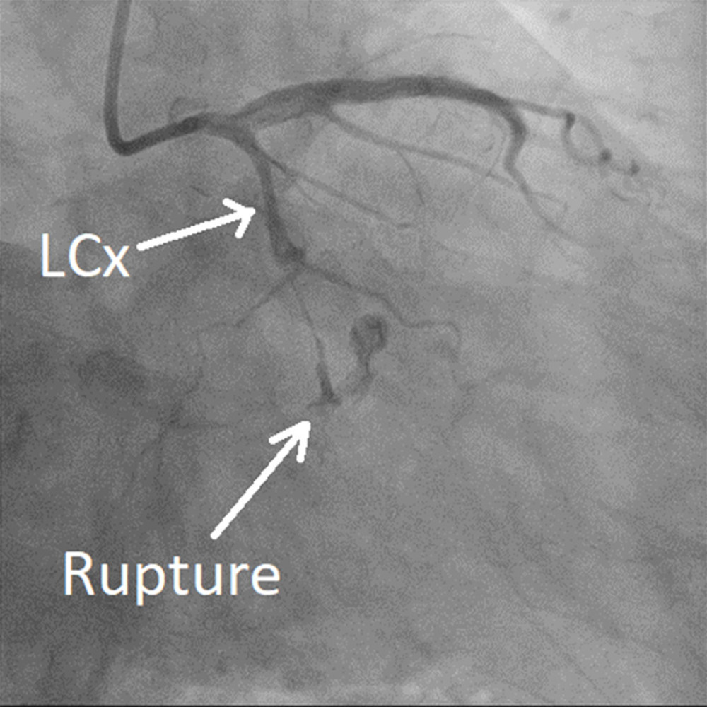 American Journal of Case Reports | Two Cases of Management of Coronary ...