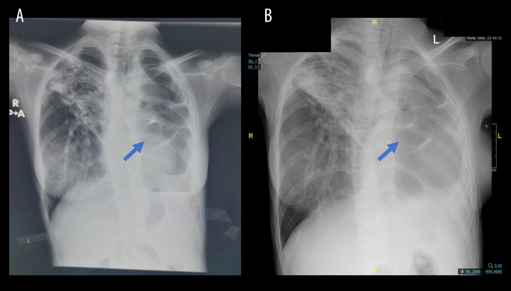 Cureus Vanishing Lung Syndrome An Idiopathic Bullous 49 Off
