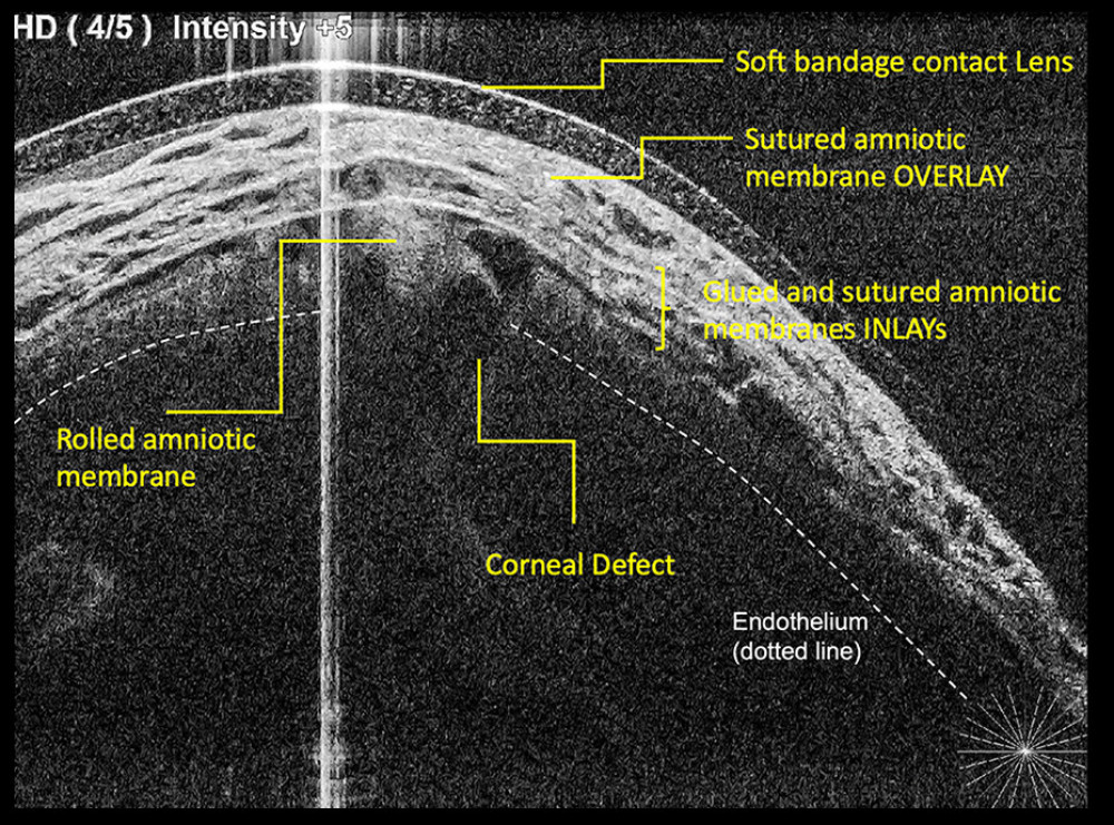American Journal of Case Reports | Corneal Perforation Repair Using a ...