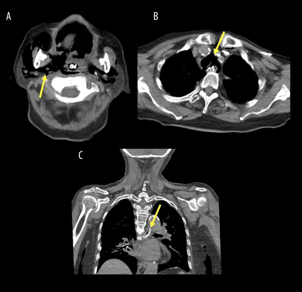 American Journal of Case Reports | Cervical Emphysema and ...