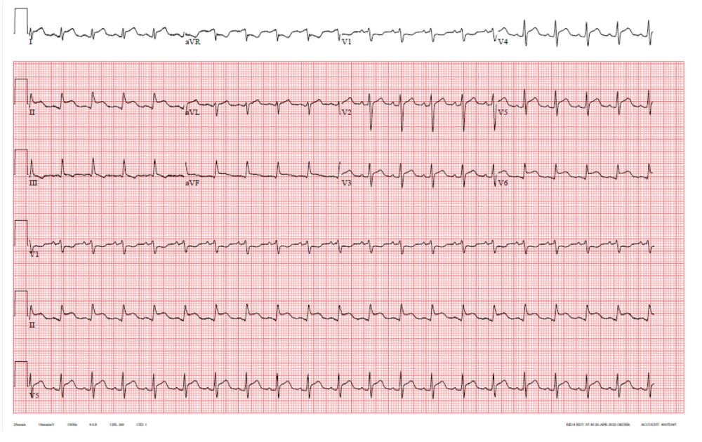Cardiac Tamponade Ecg Electrocardiographic Changes In Patients With