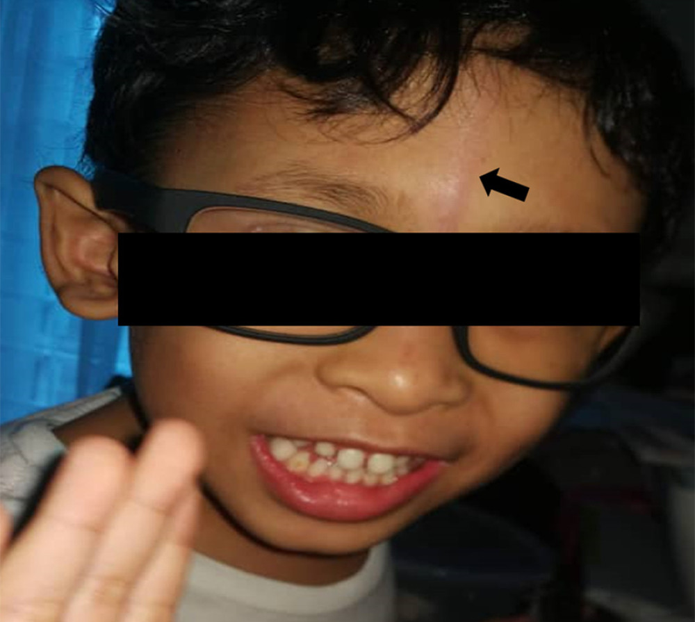 American Journal of Case Reports | A Case of Linear Scleroderma in a ...