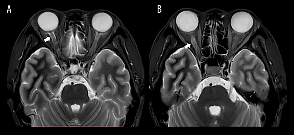 American Journal of Case Reports | Optic Neuritis Leading to Vision Loss: A Case of MOG ...