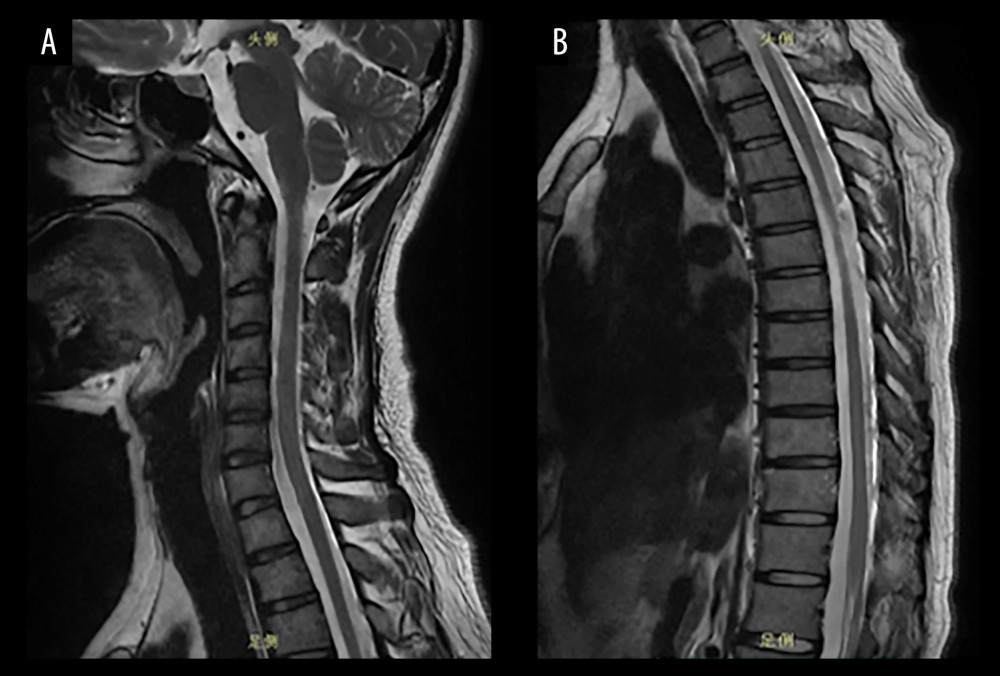 American Journal of Case Reports | Optic Neuritis Leading to Vision ...