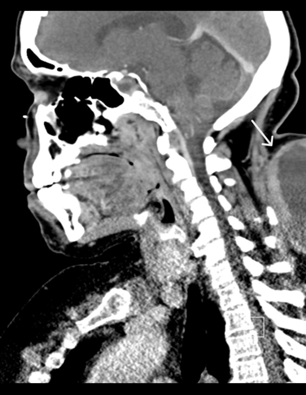 American Journal of Case Reports | Cutaneous Metastasis in Breast ...