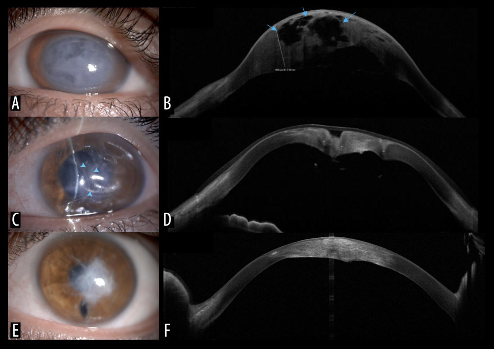 Hidropisia Da Cornea American Journal Of Case Reports | Management Of
