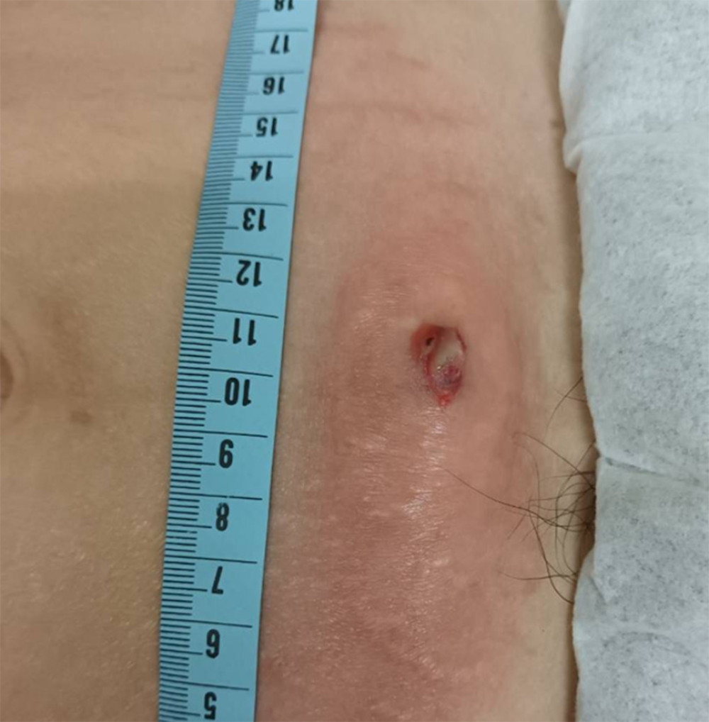 American Journal of Case Reports | Late-Onset Mesh Infection ...