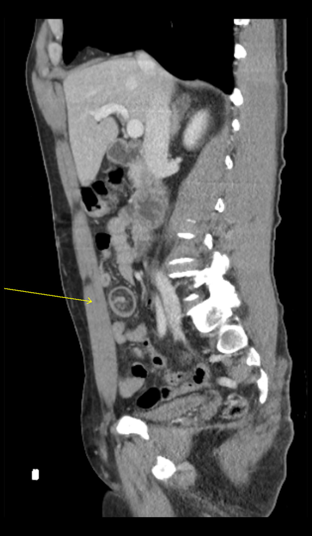 American Journal of Case Reports | Ileo-Ileal Intussusception Secondary ...