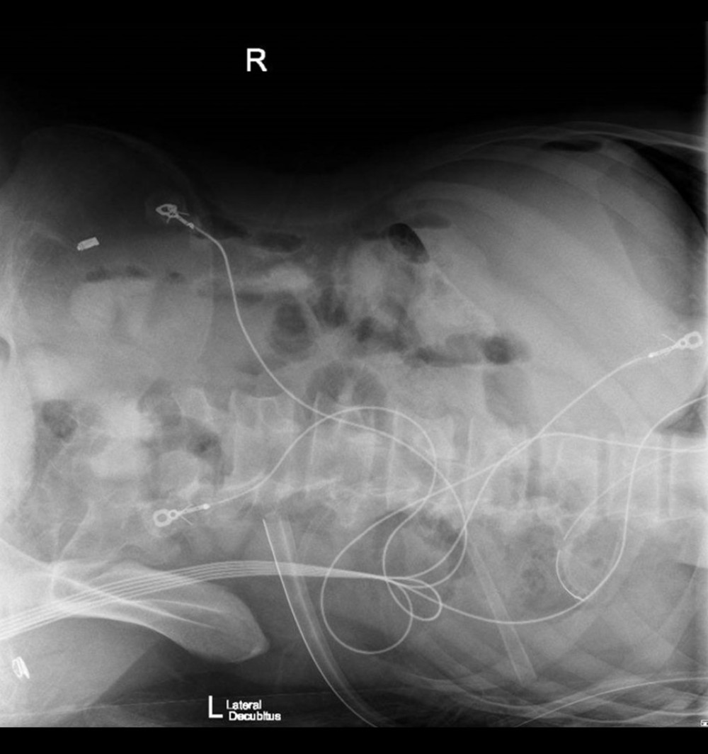 American Journal of Case Reports | Complicated Meckel’s Diverticulum ...