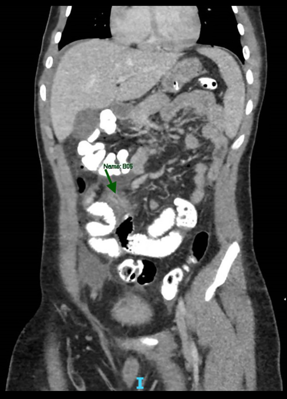 American Journal of Case Reports | Complicated Meckel’s Diverticulum ...