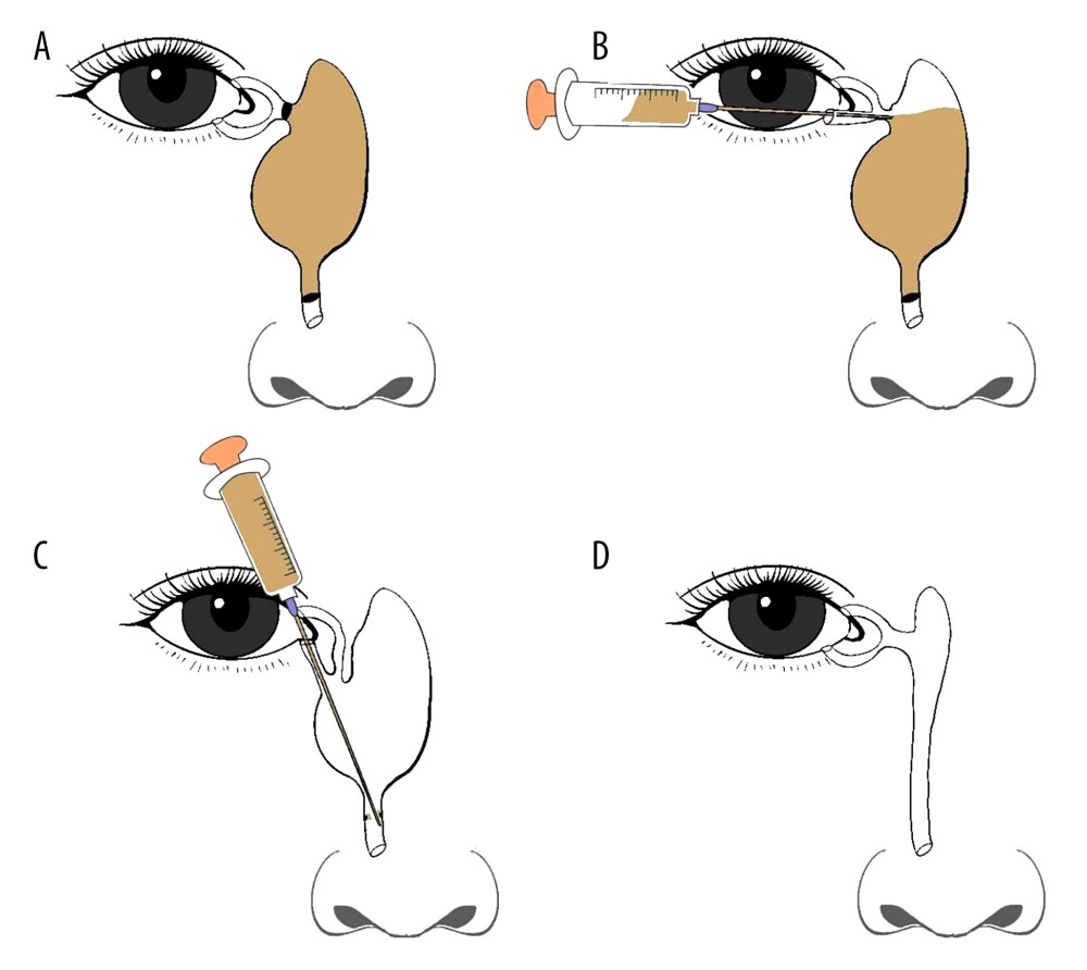 American Journal of Case Reports | Minimally Invasive Management of ...