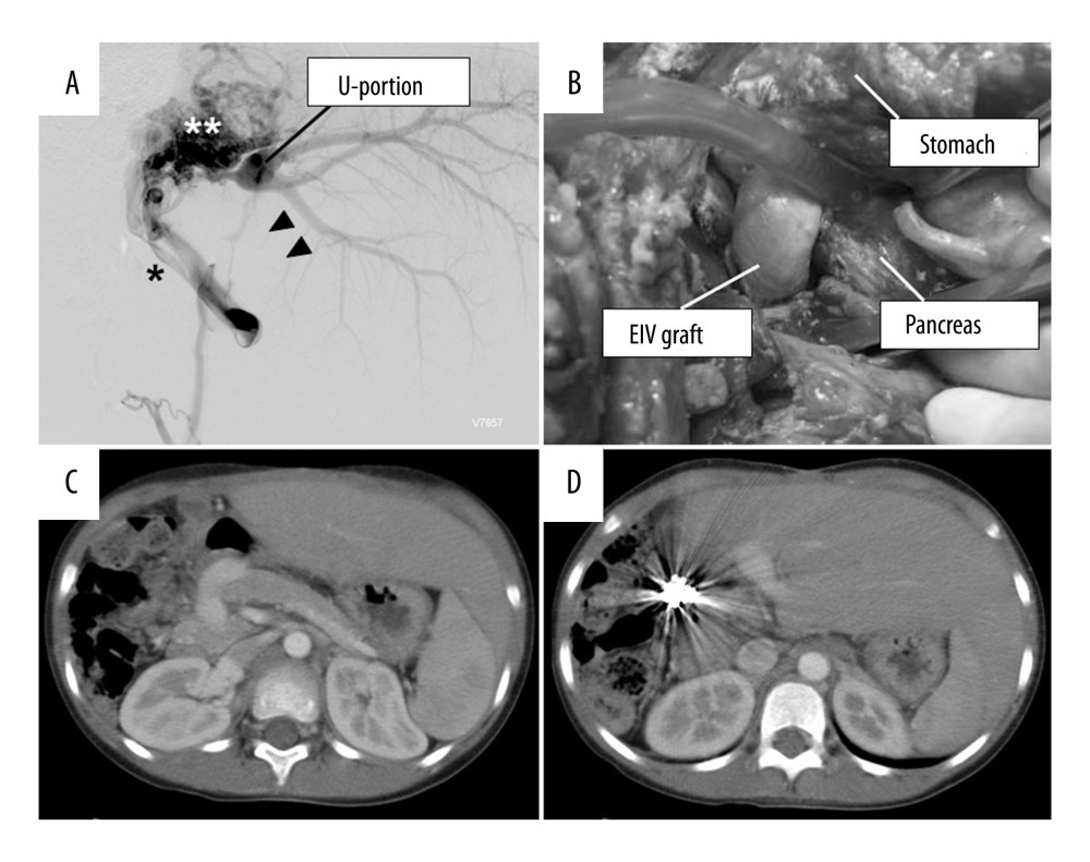 Annals of Transplantation | Rex Shunt for Portal Vein Thrombosis After ...