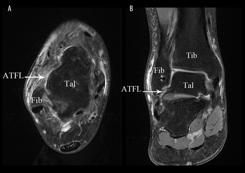 Anterior Talofibular Ligament Mri