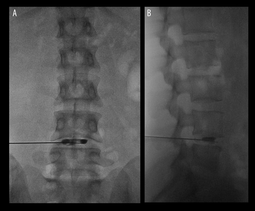 Medical Science Monitor | Efficacy of Single Level Versus Double Levels ...