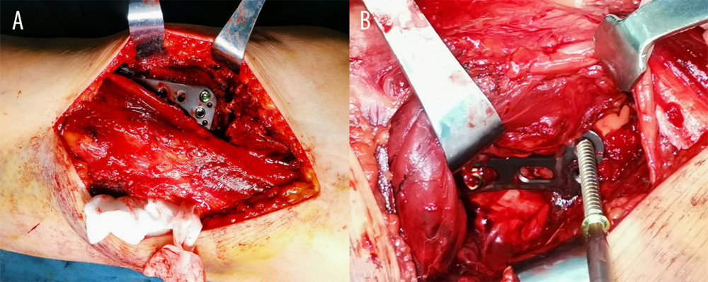 Medical Science Monitor | Retrospective Study of 23 Patients with ...