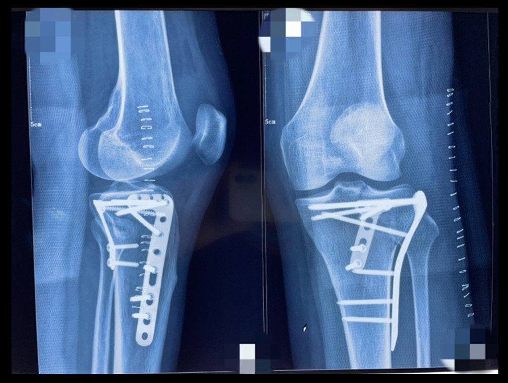 Medical Science Monitor | Retrospective Study of 23 Patients with ...