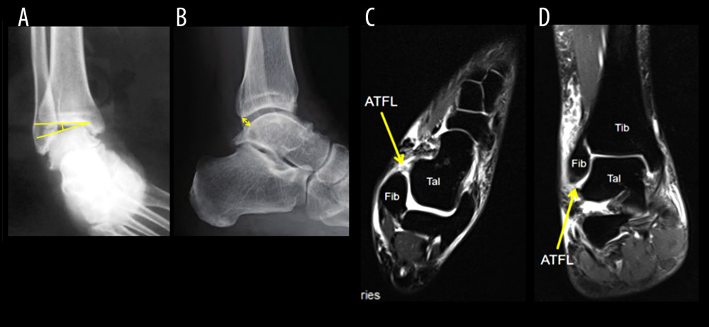 Anterior Talofibular Ligament Mri The Radiology Assistant : MRI