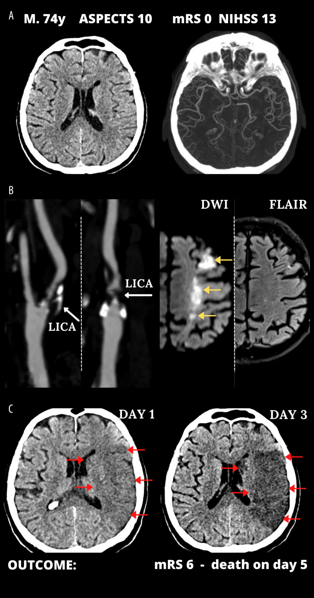 Medical Science Monitor | Clinical Outcomes of Extracranial Carotid ...