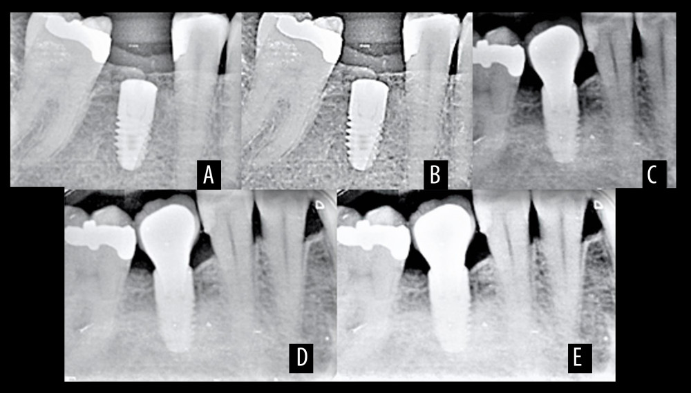 Medical Science Monitor | A Study of 42 Partially Edentulous Patients ...