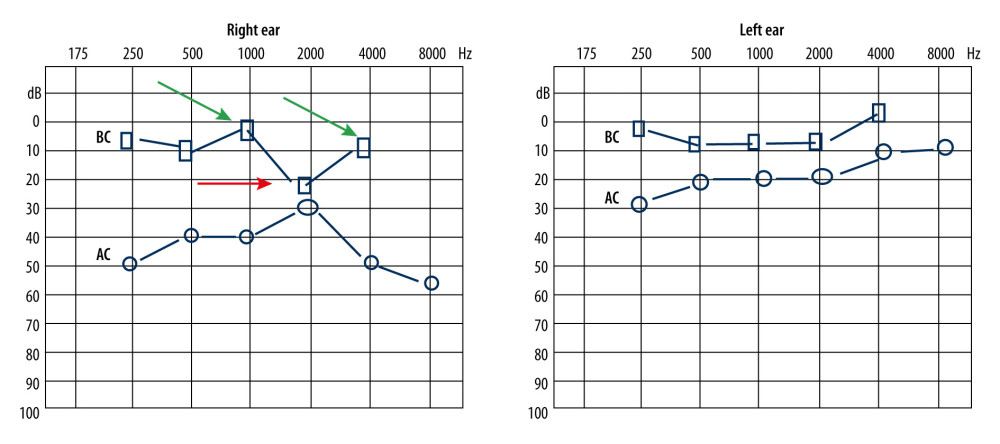 Otosclerosis Audiogram Carhart Notch Audiological Profile Of A Rare