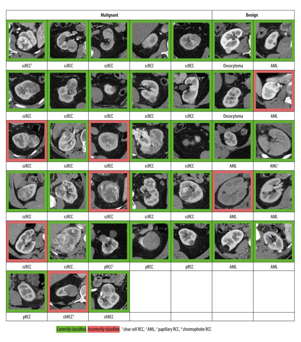 Medical Science Monitor | Enhancing Renal Tumor Detection: Leveraging ...