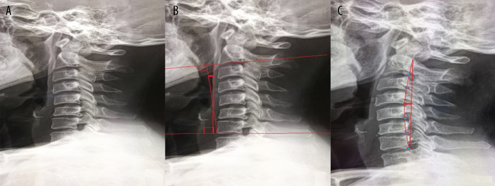 Thyroid Cartilage X Ray