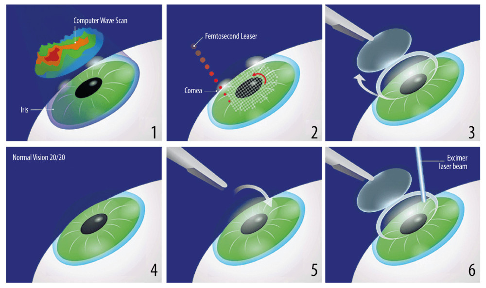 Deep Anterior Lamellar Keratoplasty