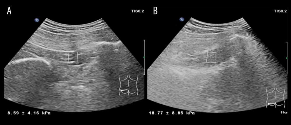 Piriformis Syndrome Ultrasound