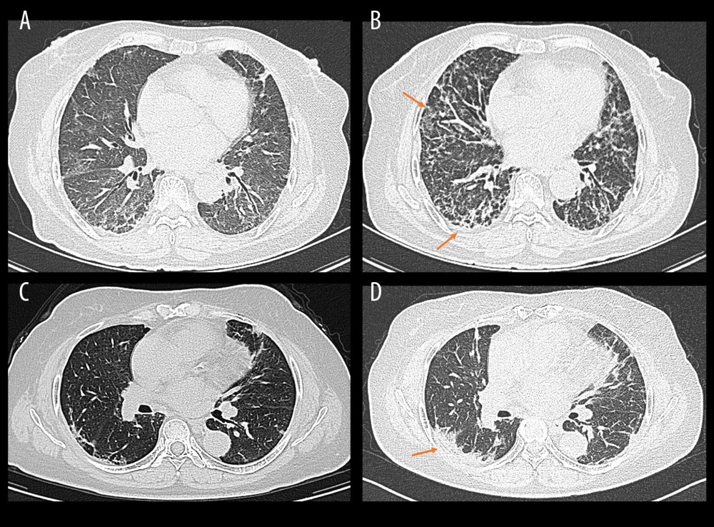 Medical Science Monitor | Risk Prediction for Rapidly Progressive ...
