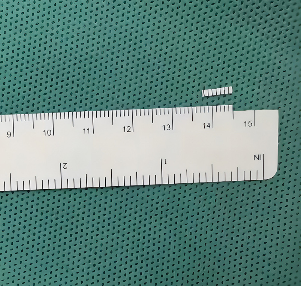 Medical Science Monitor | Use of a Flexible Ruler in Measuring the ...